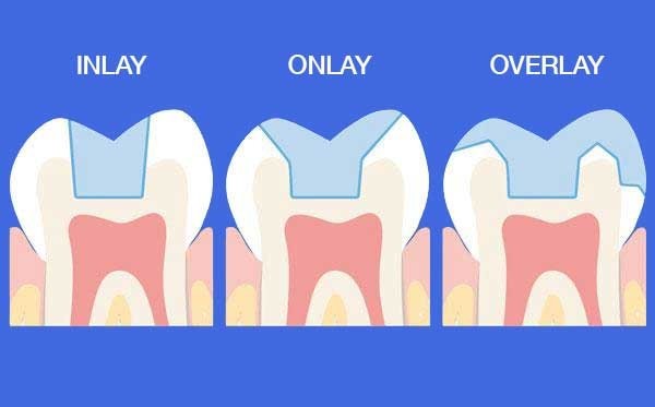 FIXED PROSTHODONTICS - hiDental - Nha khoa Xin chào